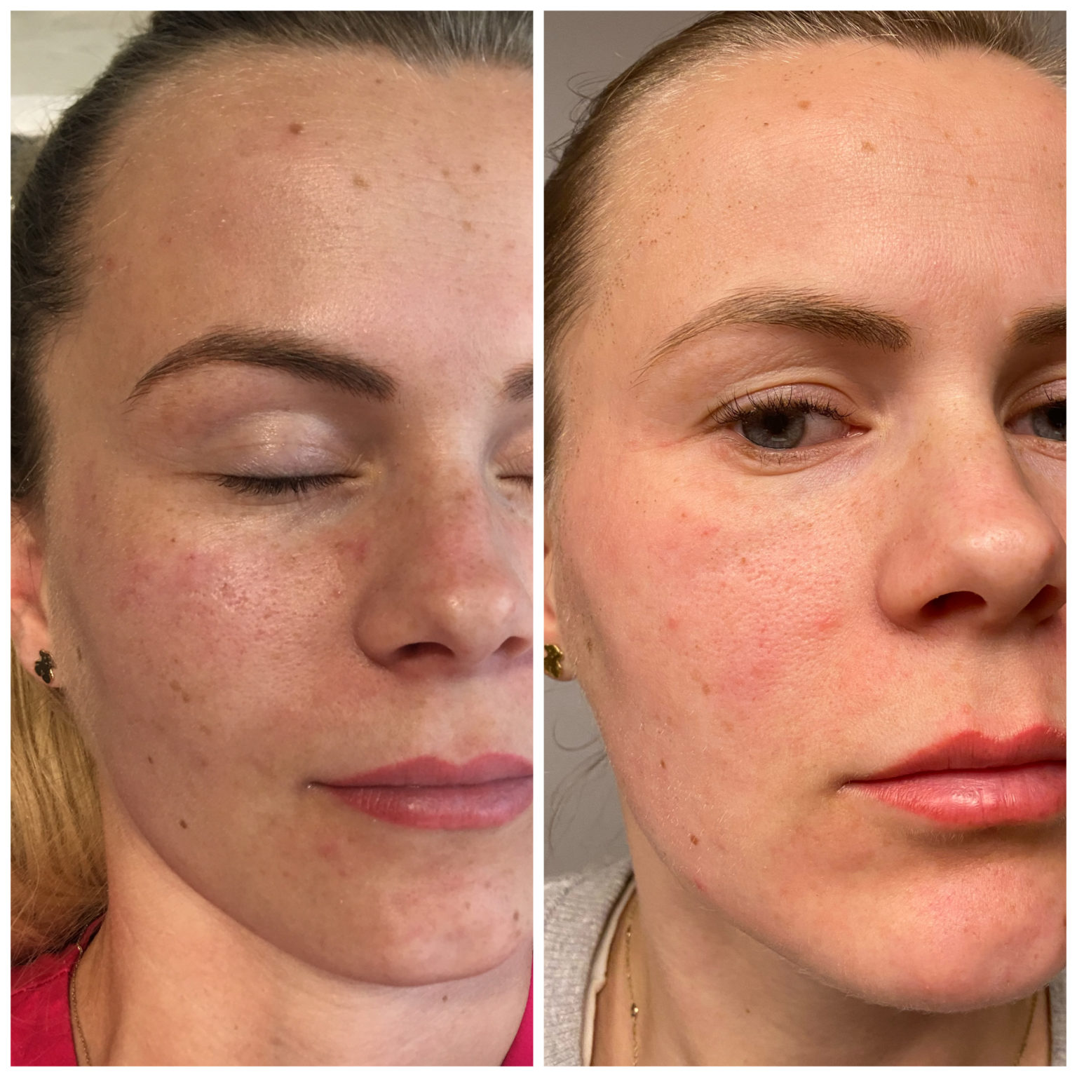 iPixel - laser frakcyjny, czy warto?