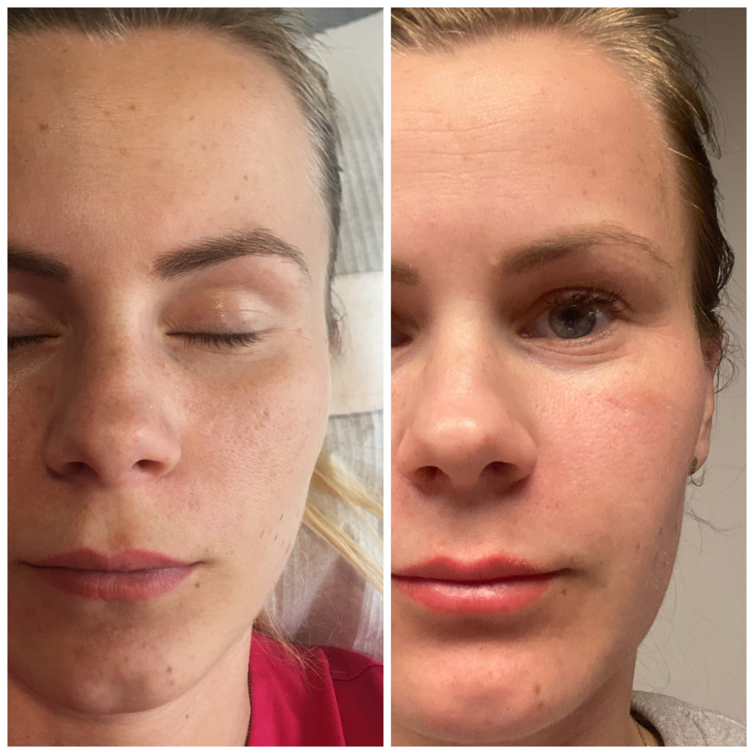 iPixel - laser frakcyjny, czy warto?